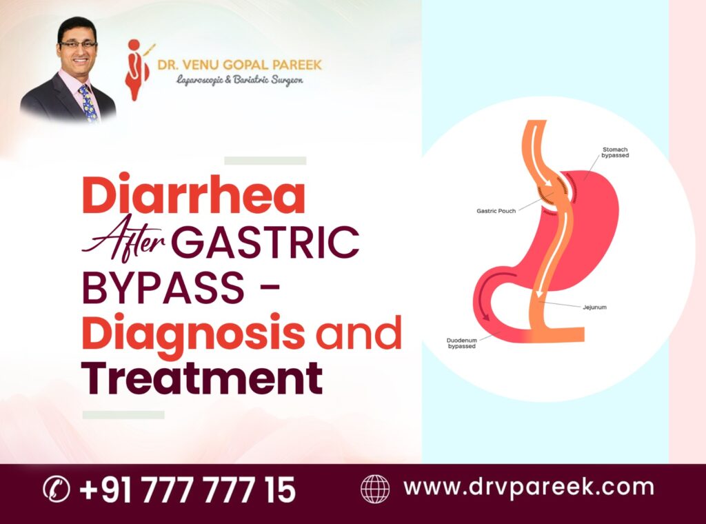 Diarrhoea After Gastric Bypass – Diagnosis and Treatment - Bariatric ...