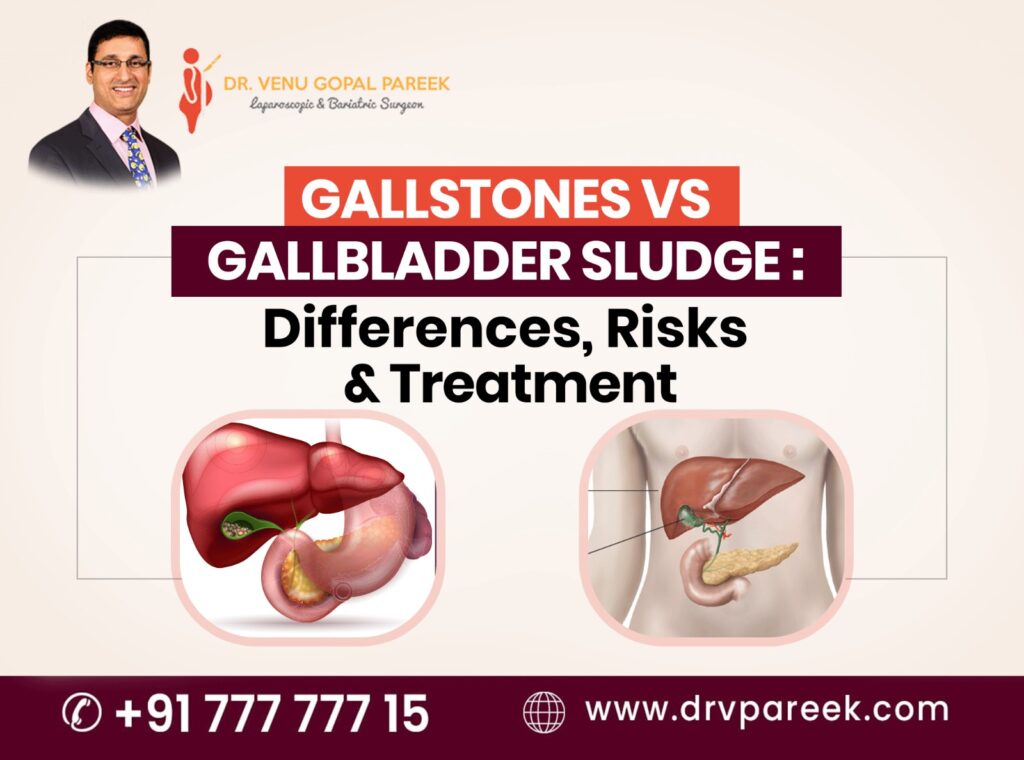 Gallstones vs Gallbladder Sludge: Differences, Risks & Treatment ...